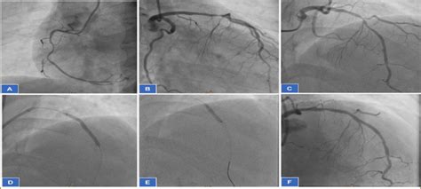 A Coronary Angiography Showing Mild Diffused Lesion In The Right