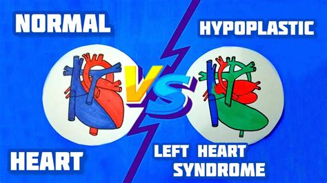 Hypoplastic Left Heart Syndrome Congenital Heart Disease Dr Deen