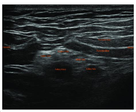 Anomalous Orientation Of The Brachial Plexus At The Level Of The