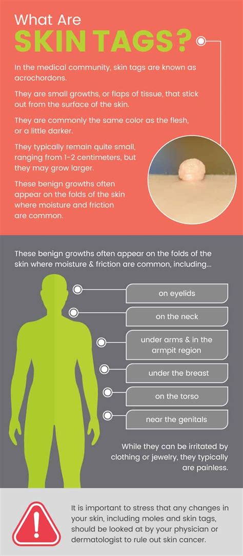 Cancerous Skin Tags Removal