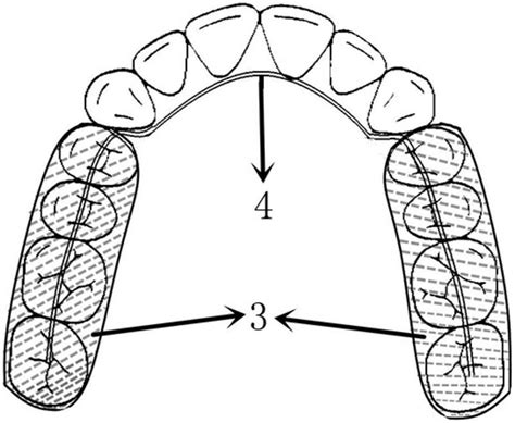 舌杆式垫矫治器 爱企查