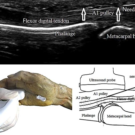Ultrasound Guided Percutaneous A1 Pulley Release By Needle Knife
