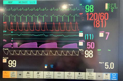 Sean Scott On Twitter Upsloping Obstructive Etco2 Trace From Severe Asthma Patient Foamed