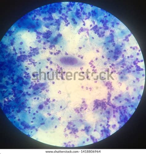 Стоковая фотография 1418806964 Genital Herpes Infection By Herpes