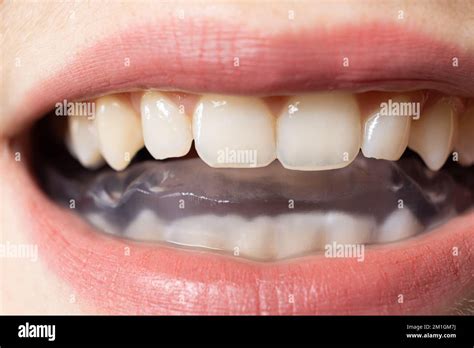 What Does A Mouth Splint Do For Tmj At Jack Radcliffe Blog