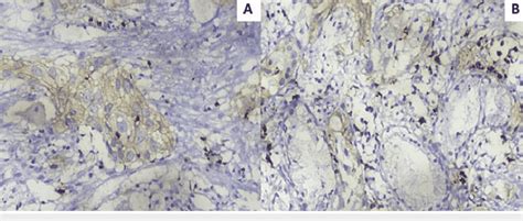 Pd L1 Positivity In Lymphocytes Ihc X400 A Tumor Cells Showing
