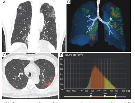 Figure 4 From A Deep Learning Based Quantitative Computed Tomography Model For Predicting The