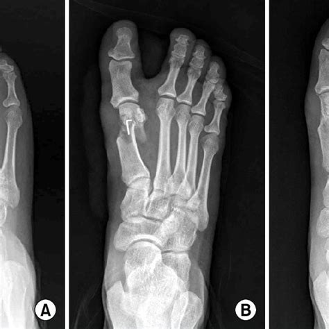 The Right Foot Of 46 Year Old Female Shows Moderate Hallux Valgus