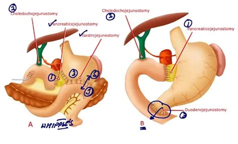 Pancreatic Cancer Neuroendocrine Tumors Of Pancreas Prepladder