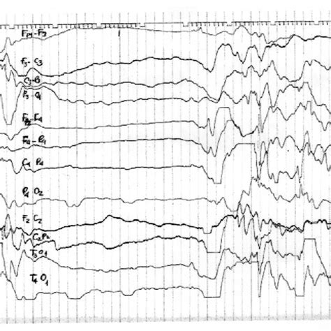 Sleep Encephalogram Burstsuppression Pattern The Burst Lasted 2 To 6