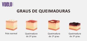 Como Identificar O Grau De Uma Queimadura Vuelo PharmaVuelo Pharma