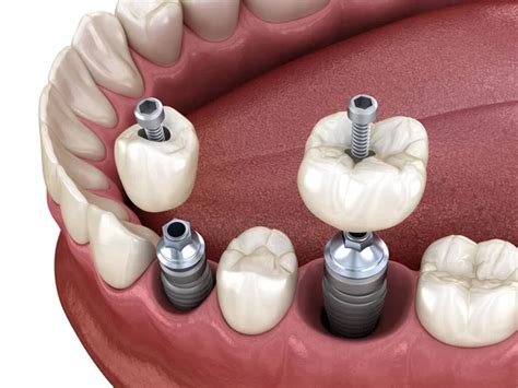 Instalação Coroa Dente Pré Molar Molar Sobre Implante Fixação Parafuso Fotografias de Stock