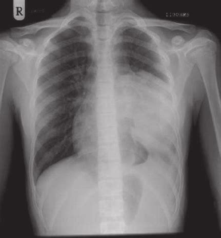 4 Chest X Ray Of Mediastinal Mass Hl Download Scientific Diagram
