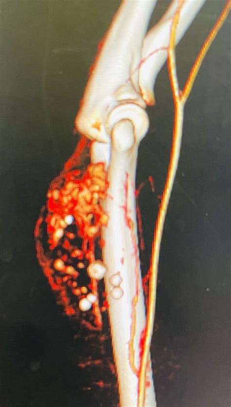 Ct Angiogram Upper Limb Md Fayej Ullah