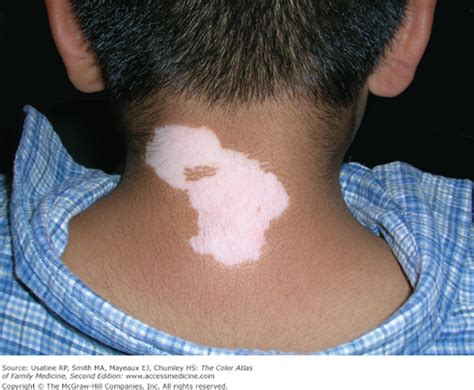 Vitiligo And Hypopigmentation Basicmedical Key