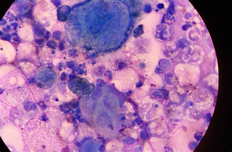 Apa Itu Herpes Di Mata Yuk Ketahui 4 Cara Mengbobatinya