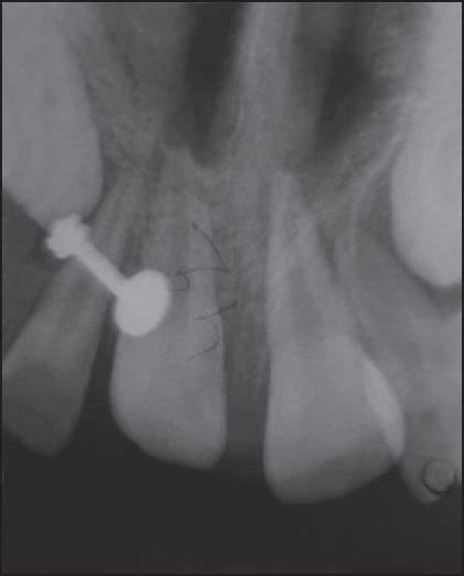 Pre Operative Periapical Radiograph Of Intruded 11 12 And 22 Patient