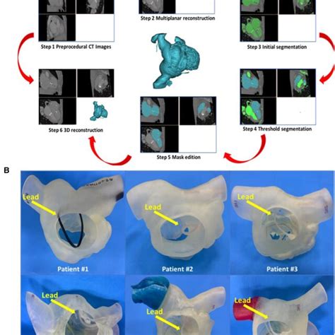 Preoperative 3d Reconstruction And 3d Printed Models Of All 6 Patients