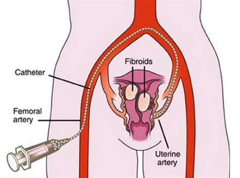 Uterine Fibroid Embolisation South Tees Hospitals Nhs Foundation Trust