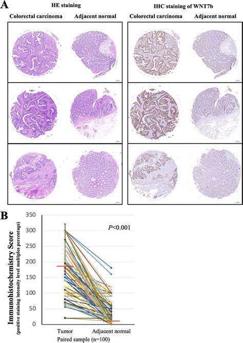 Wnt7b Expression Was Upregulated In Crc Tissue A Representative