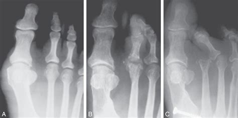 Lesser Toe Deformities Clinical Tree