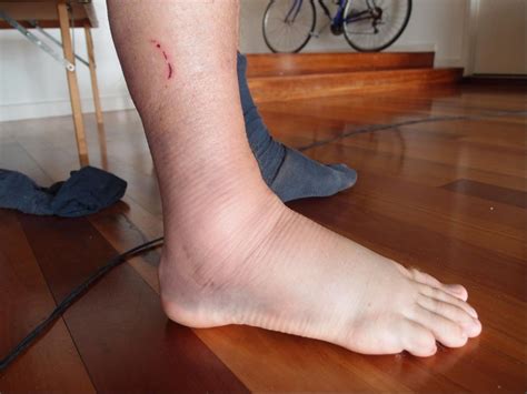 Torn Ankle Ligament