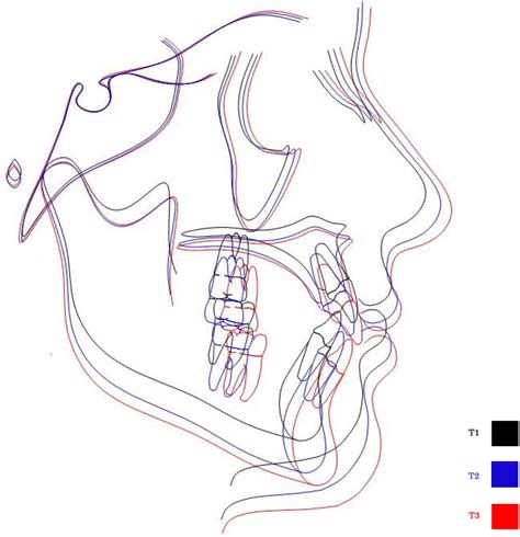 Figure 1 From Long Term Soft Tissue Profile And Incisor Angulation Of