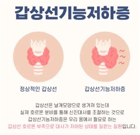 갑상선 기능 저하증과 항진증 차이 증상 및 수치