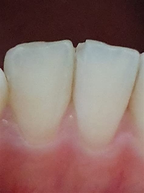 Very Small Chipped Tooth Dentistry