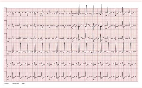 Figure 3 From Recurrent Giant Cell Myocarditis Following Orthotopic