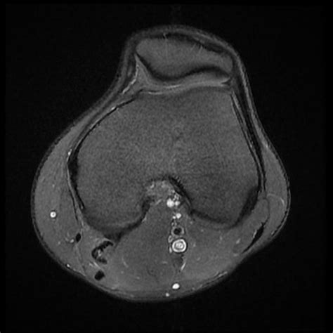 Discoid Medial Meniscus With Horizontal Tear Bilateral Image