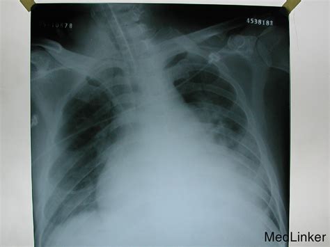 Ecmo用于心衰病人等候心脏移植一例 医联
