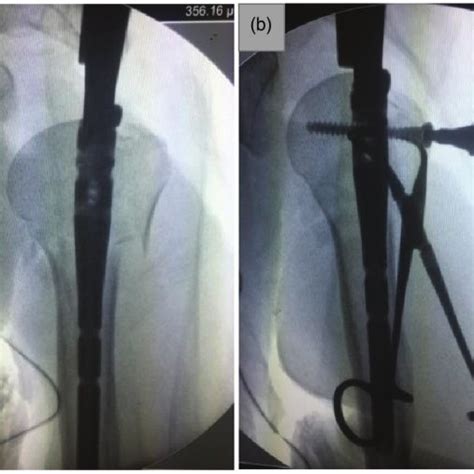 Typical Intraoperative Radiography Showing The Reduction During Surgery Download Scientific