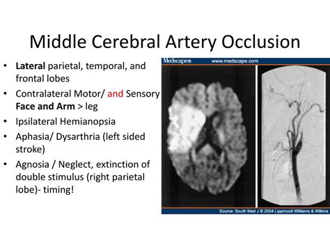Evaluation Of The Middle Cerebral Artery Occlusion Techniques In The