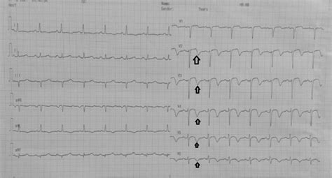 Ecg T Wave Inversion In Leads V2 V5 And Slight St Segment Elevation In Download Scientific