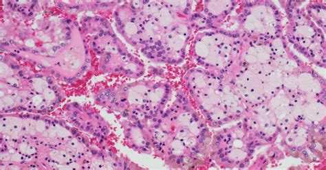 Papillary Renal Cell Carcinoma Risk Factors Signs Treatment And Prognosis