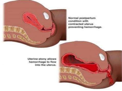 Post Partum Hemorrhage Pphppt