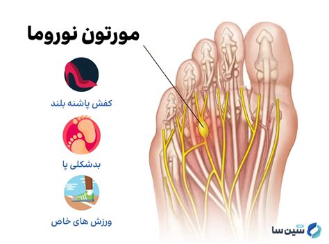 مورتون نوروما علل بروز، نشانه ها، روش تشخیص و درمان