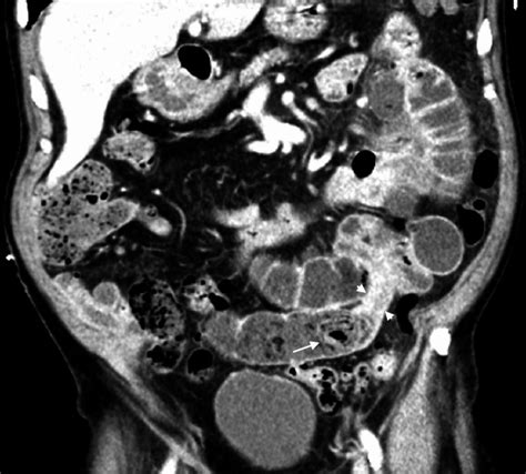 Enterolith Ileus And Jejunal Diverticulitis From Jejunal Diverticulosis