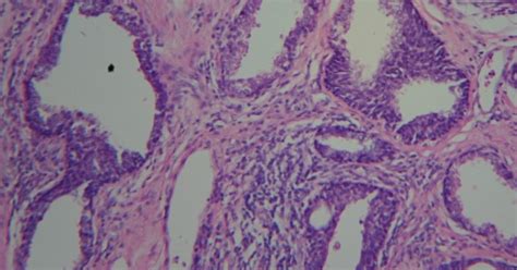 Healthy Prostatic Fluid Is Essential For Male Fertility Panaxea International Au