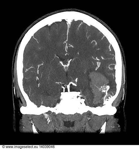 Temporal Lobe Hemorrhage And Avm Temporal Lobe Hemorrhage And Avm