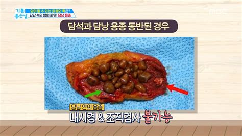 알아둬야 할 내 몸의 혹 췌장 낭종and담낭 용종