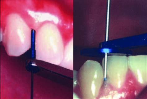 The Florida Probe This Electronic Force Controlled Probe Has A