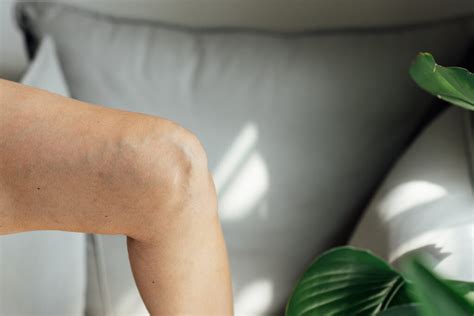 Early Stages Of Varicose Veins Recognizing The Signs And Symptoms West