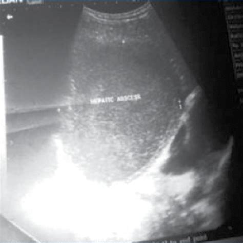 A Well Defined Rounded Area Of Mixed Echogenicity Measuring 134 X