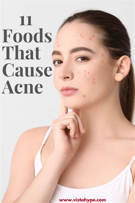 11 Foods That Can Trigger Acne And Bad Skin In 2024 Acne Causing