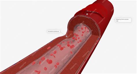 Premium Photo An Arteriotomy Is A Cut Or Opening That Is Made Into