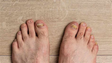 Tips To Manage Foot And Toenail Fungus Onlymyhealth