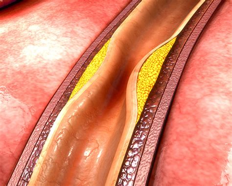 Peripheral Vascular Market Nordson Medical