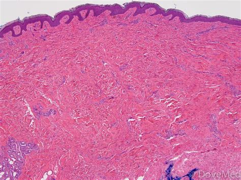 Diffuse Systemic Scleroderma Dovemed